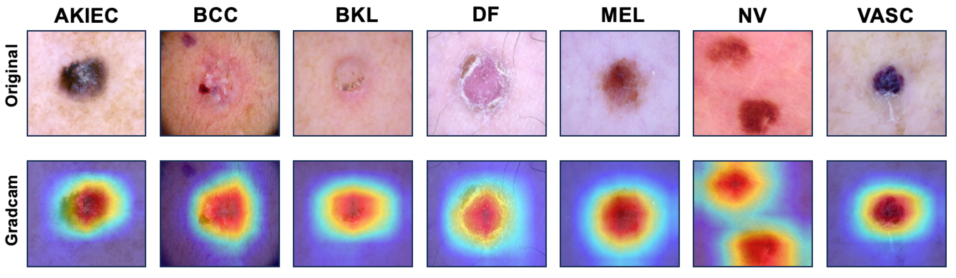 An Enhanced Approach Using AGS Network for Skin Cancer Classification