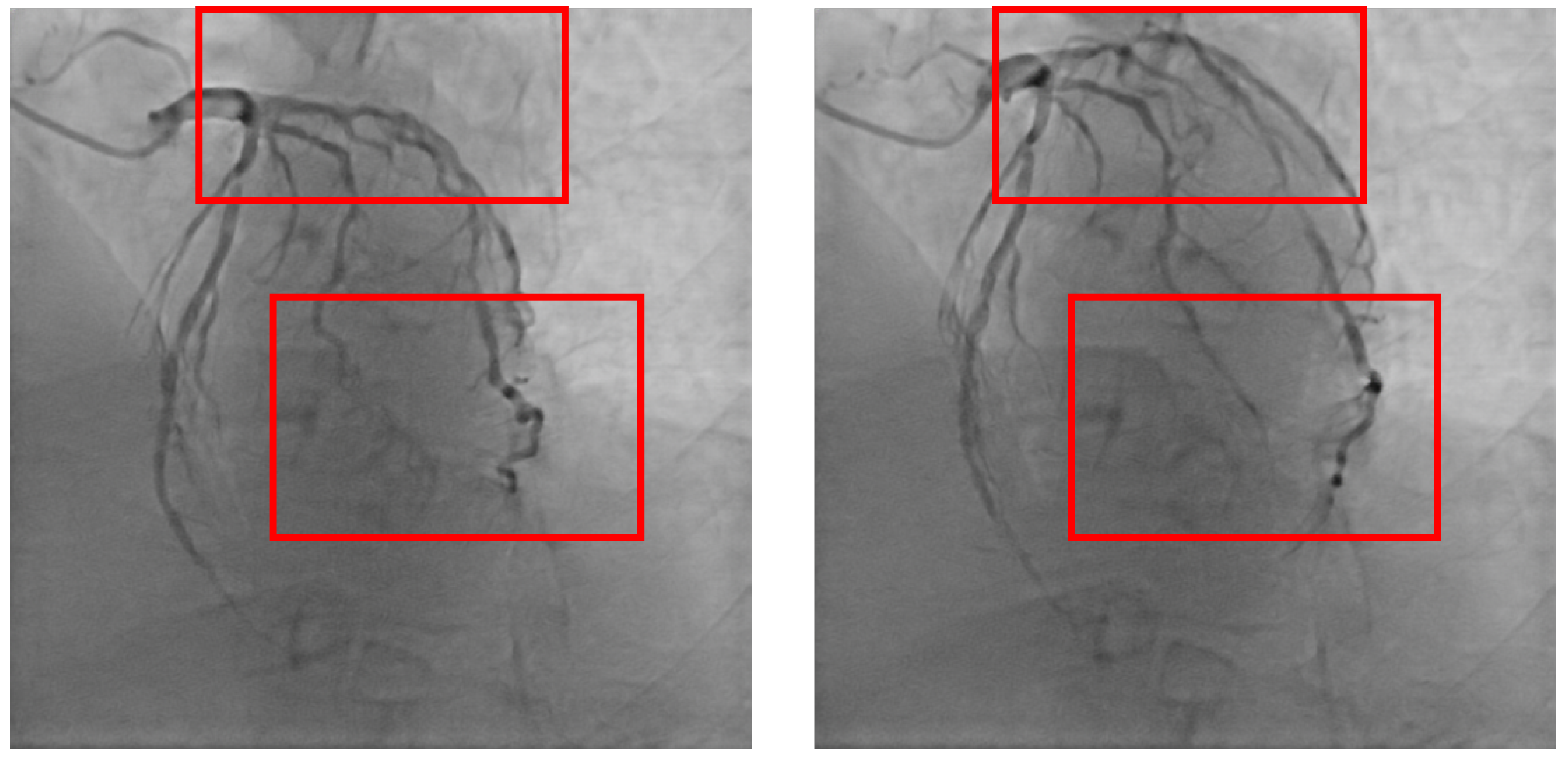 CDKD-w+: A Keyframe Recognition Method for Coronary Digital Subtraction Angiography Video ...