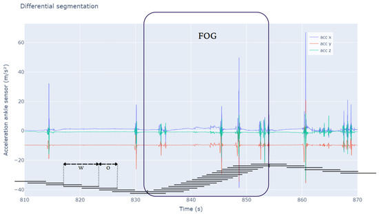 Ankle Sensor-Based Detection of Freezing of Gait in Parkinson’s Disease ...