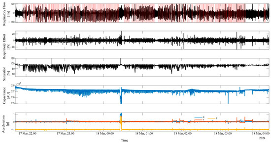 An Automated Algorithm for Obstructive Sleep Apnea Detection Using a Wireless Abdomen-Worn Sensor