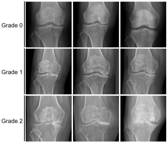 Classification of Grades of Subchondral Sclerosis from Knee ...