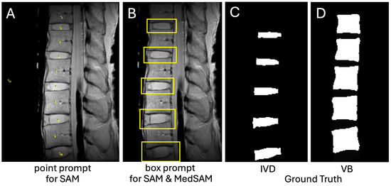 Segment Anything Model (SAM) and Medical SAM (MedSAM) for Lumbar Spine MRI