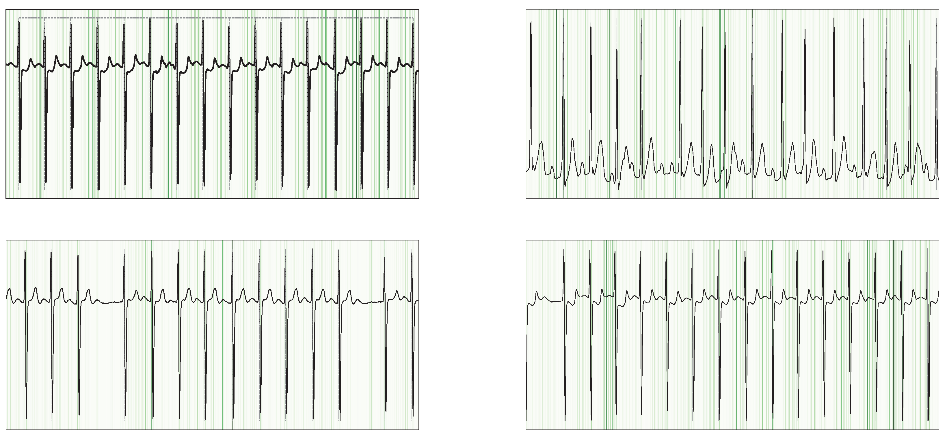 Atrial Fibrillation and Atrial Flutter Detection Using Deep Learning