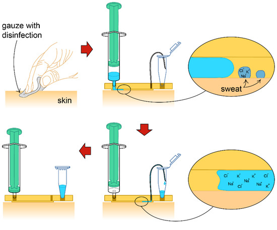 3D Printed Skin-Wash Sampler for Sweat Sampling in Cystic Fibrosis ...