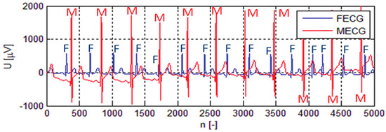 Non-Invasive Fetal Electrocardiogram Monitoring Techniques: Potential ...