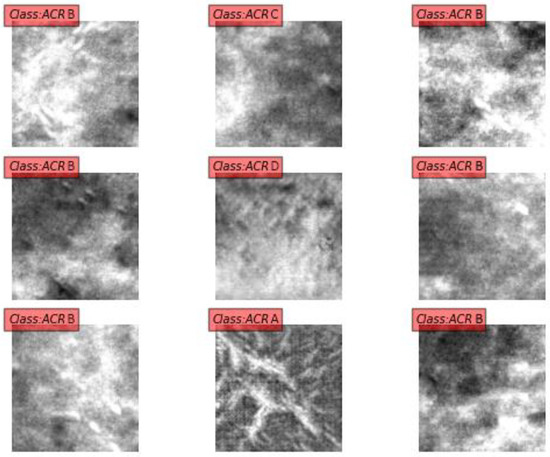 Breast Density Transformations Using CycleGANs for Revealing Undetected Findings in Mammograms