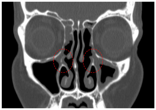Technical Quality of Contemporary Endoscopic Sinus Surgery: An ...