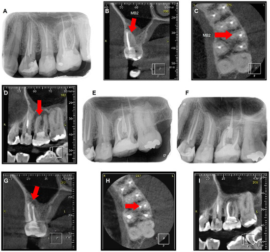 Odontogenic Sinusitis of Endodontic Origin: Successful Management ...