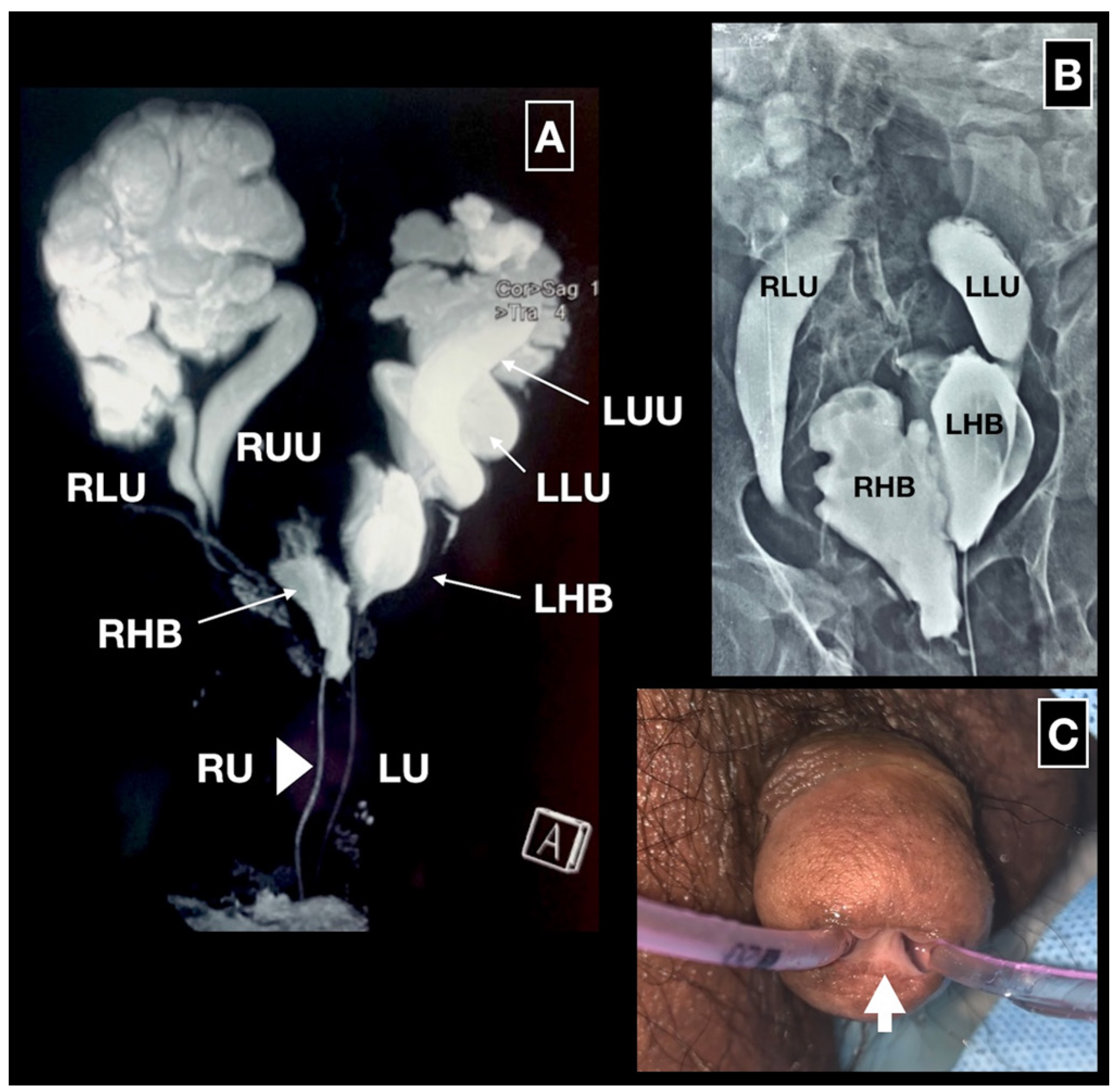 Double Trouble! Rare Complete Duplication of the Entire Urinary Tract ...