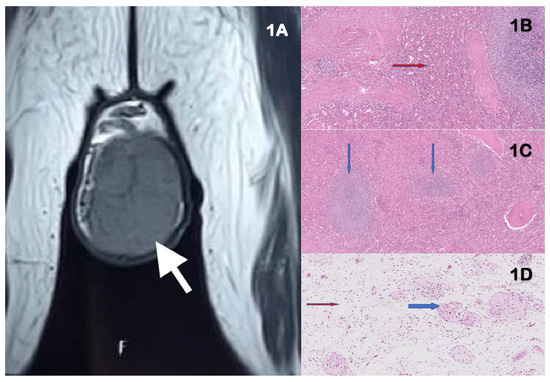 Large Accessory Scrotal Spleen Masquerading as Testicular Tumor