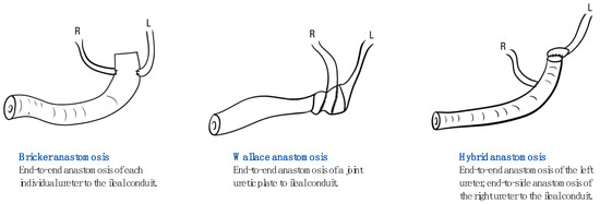 Hybrid Ureteroenteric Anastomosis Is Associated With Lower Stricture ...