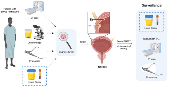 Urinary Tumor DNA-Based Diagnosis and Surveillance for Nonmuscle-Invasive Bladder Cancer—Current ...