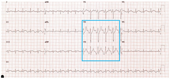 The “Spiked Helmet Sign”, a Mimic of ST-Elevation Myocardial Infarction ...