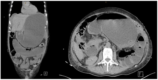 The “Spiked Helmet Sign”, a Mimic of ST-Elevation Myocardial Infarction ...