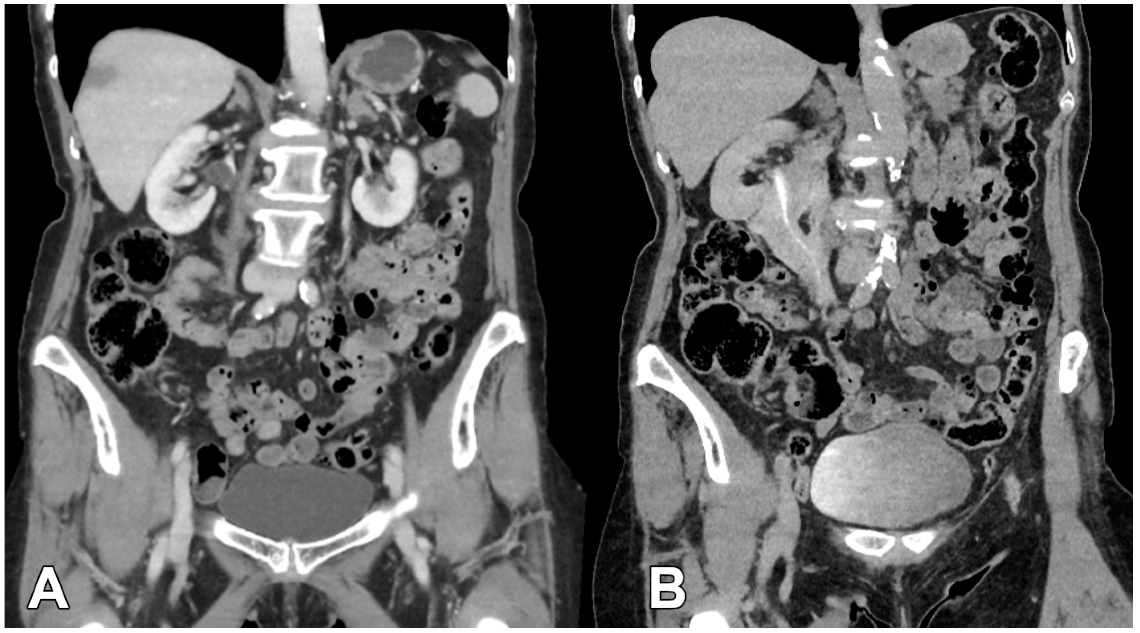 Spontaneous Calyceal Rupture from an Unusual Source