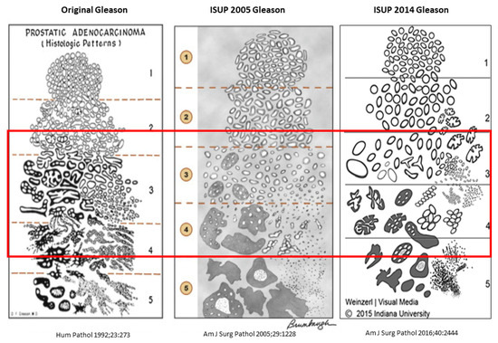 SIU-ICUD: Localized Prostate Cancer: Pathological Factors That ...