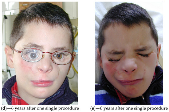 Surgical Strategy for the Treatment of Facial Clefts