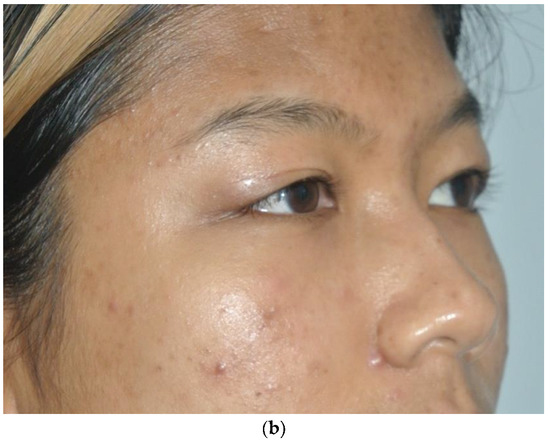 Lacrimal Gland Prolapse: Case Report