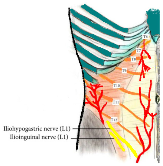 Iliohypogastric Nerve Block