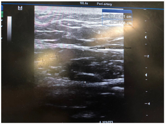 Minimally Invasive Peritoneal Dialysis Catheter Insertion with ...