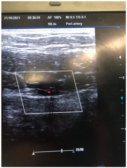 Minimally Invasive Peritoneal Dialysis Catheter Insertion with ...