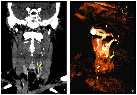 Ultrasound-Assisted Removal of a Wooden Foreign Body Embedded in the Neck