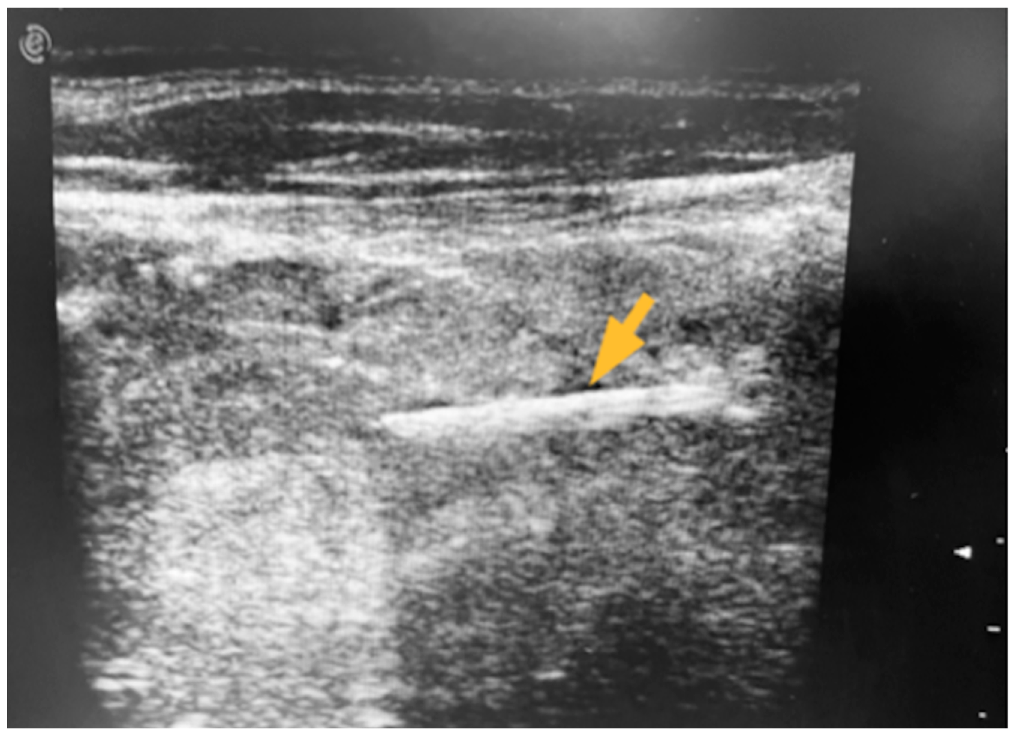 Ultrasound-Assisted Removal of a Wooden Foreign Body Embedded in the Neck