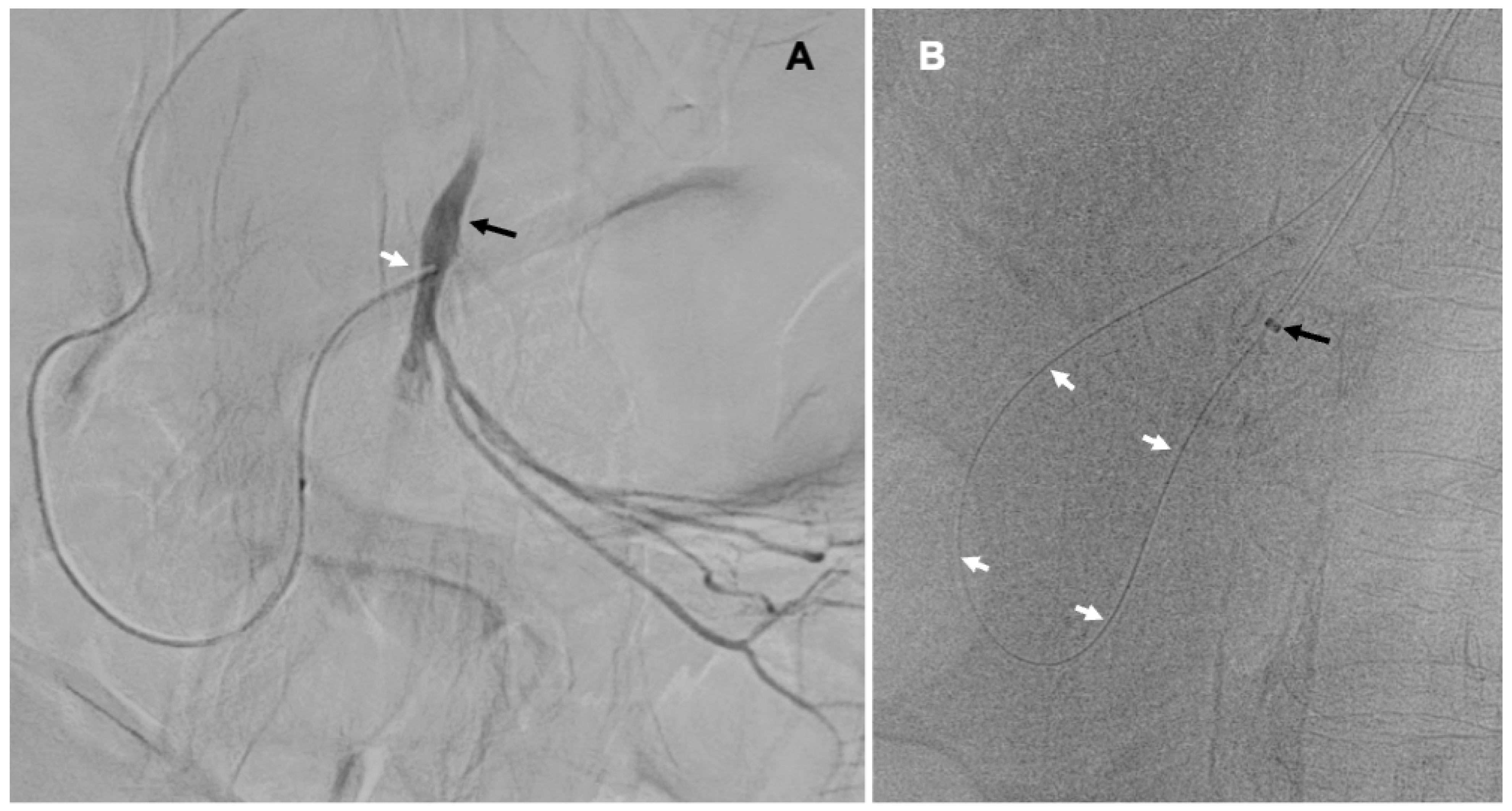 Retrograde Endovascular Recanalization of the Superior Mesenteric ...