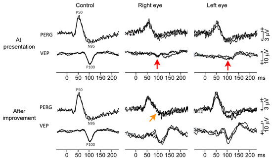 Oxidative Stress in Antibiotic Toxic Optic Neuropathy Mimicking Acute ...