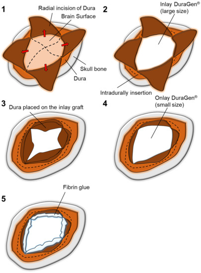 Surgeries | Free Full-Text | A Multilayered Dural Repair Technique ...