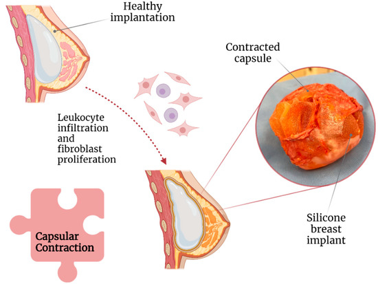 Surgeries Free Full Text Breast Implant Illness Surgical