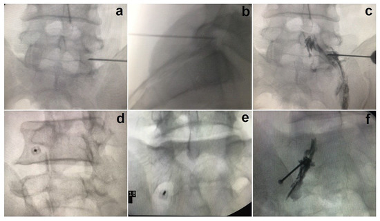 Selective Nerve Root Block in Treatment of Lumbar Radiculopathy: A ...