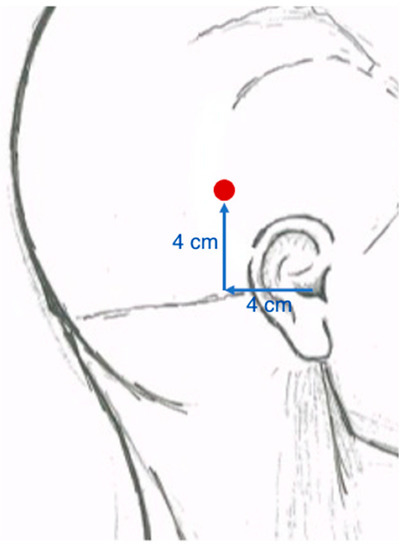 Ventricular Peritoneal Shunting Using Modified Keen’s Point Approach ...