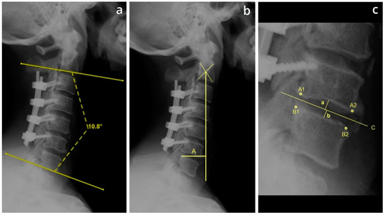 Risk Factors for Adjacent Segment Problems after Posterior ...