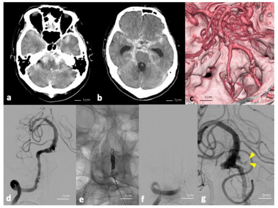 Surgeries | Free Full-Text | Partial Clipping and Multilayered Wrapping ...