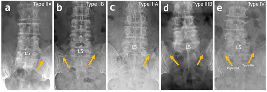 Prevalence of Lumbosacral Transition Vertebrae in Symptomatic Adults ...