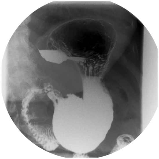 Management of Large Subcardial Diverticula in Sleeve Gastrectomy ...