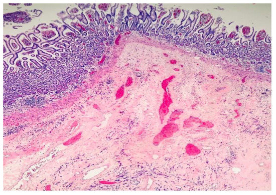 Surgeries | Free Full-Text | Post-Radiation Angiosarcoma (PRA) of the ...