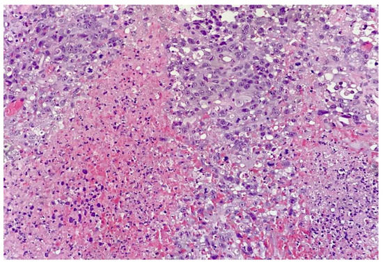 Surgeries | Free Full-Text | Post-Radiation Angiosarcoma (PRA) of the ...