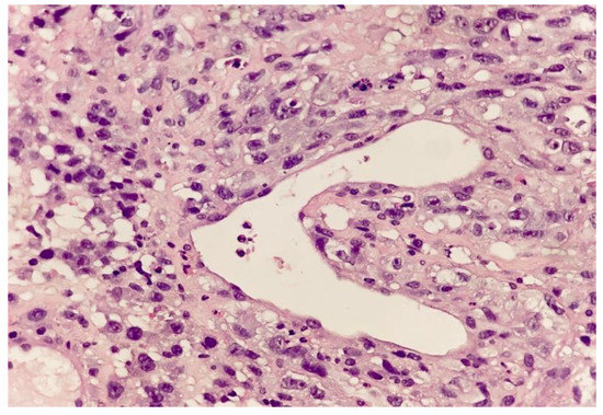 Surgeries | Free Full-Text | Post-Radiation Angiosarcoma (PRA) of the ...