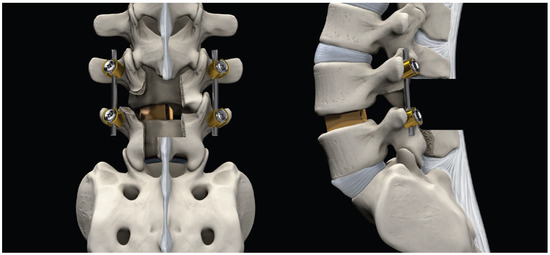 Preservation of the Posterior Interspinous Ligamentary Complex in ...