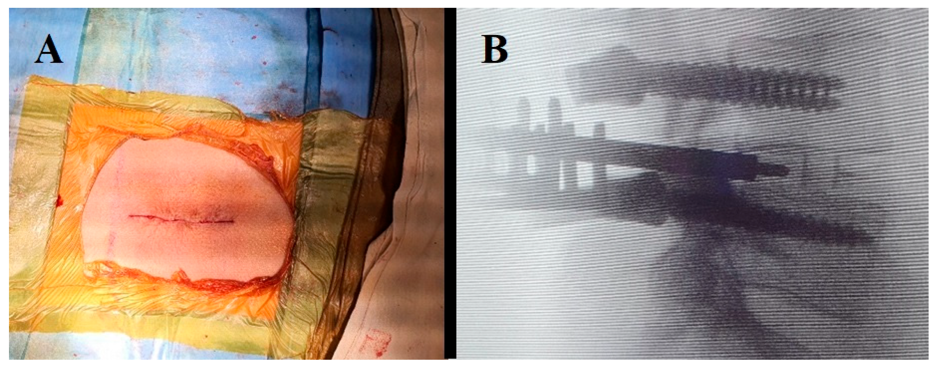 Comparative Analysis of Open Transforaminal Lumbar Interbody Fusion and ...