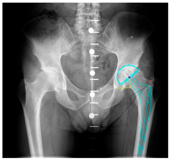 Accurate Restoration of the Center of Rotation of the Hip Joint Based ...