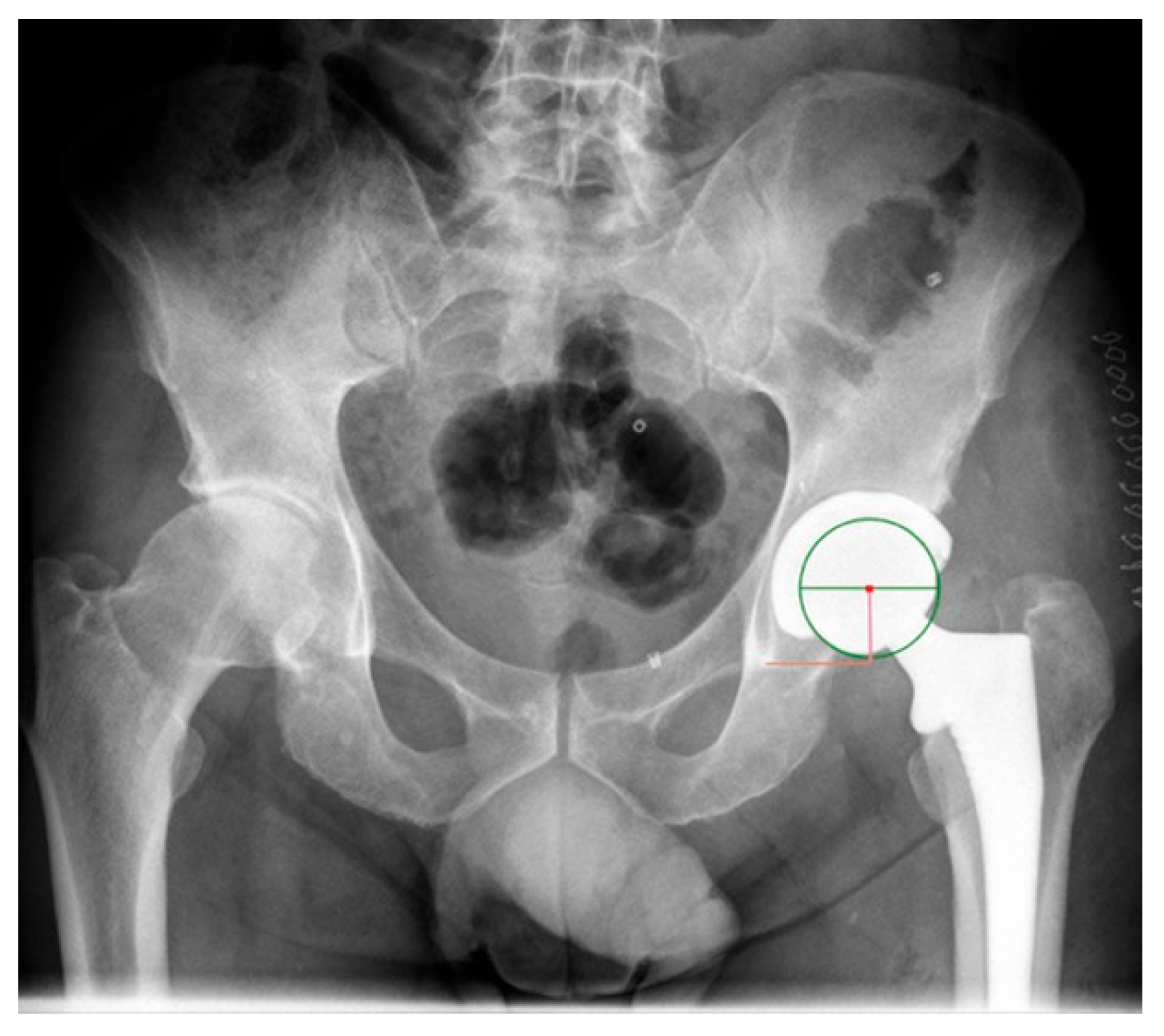 Accurate Restoration of the Center of Rotation of the Hip Joint Based ...