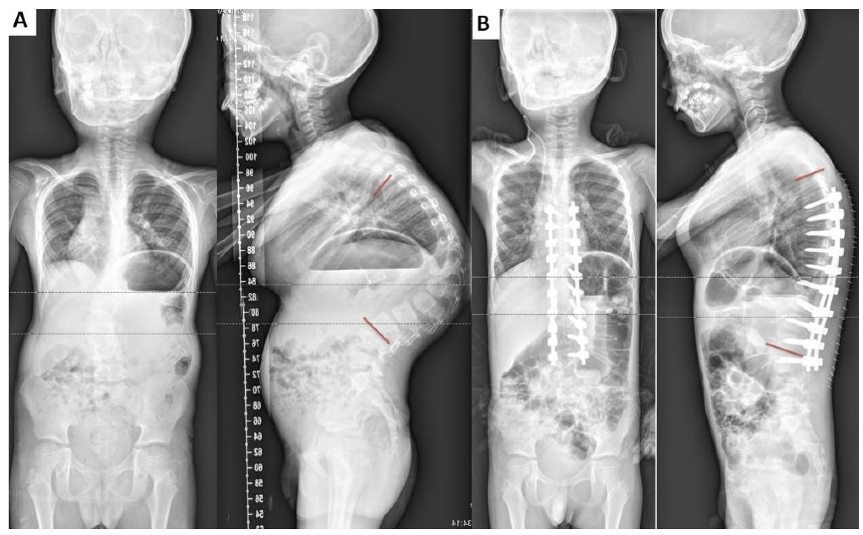 Posterior Spinal Fusion for Severe Kyphosis in a Child with Gaucher ...