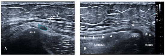 Meralgia Paresthetica: Neurolysis or Neurectomy?