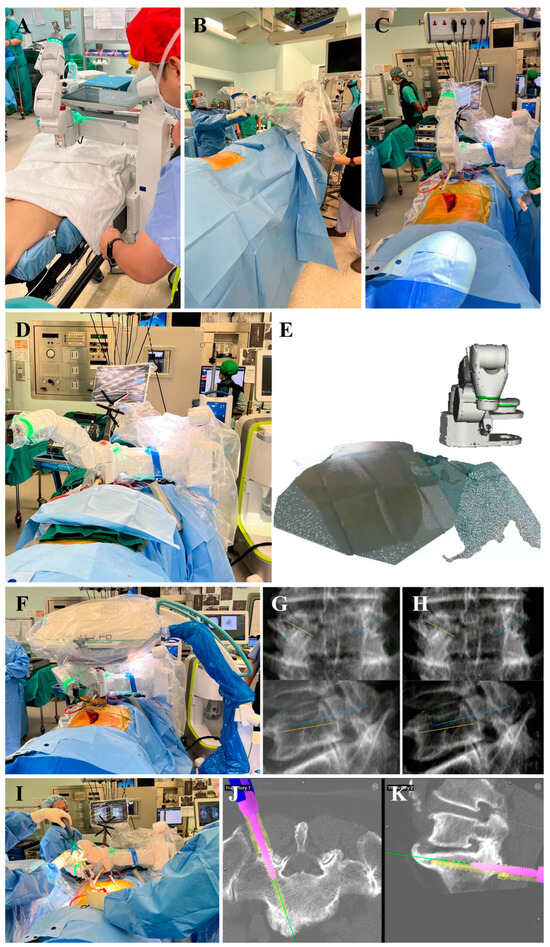 Overcoming the Learning Curve in Robot-Assisted Spinal Surgery—How Does ...