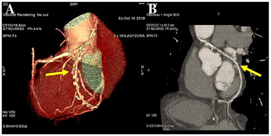 Radial Artery Used as Conduit for Coronary Artery Bypass Grafting