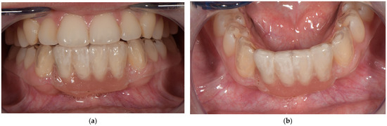 Odontogenic Myxoma in the Anterior Part of the Mandible—A Case Report