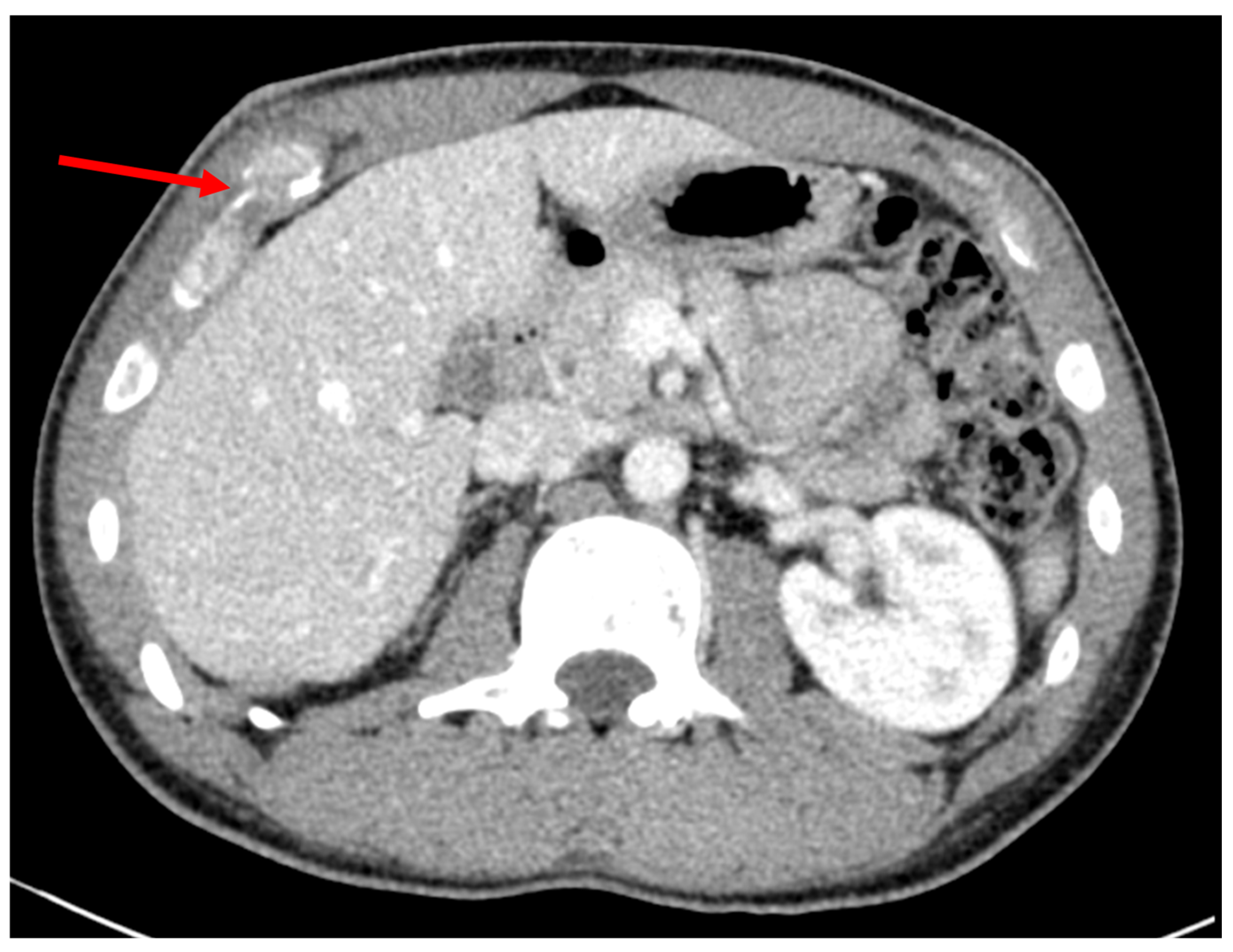 Epidemiology of Symptomatic Non-Union/Malunion Rib Fractures